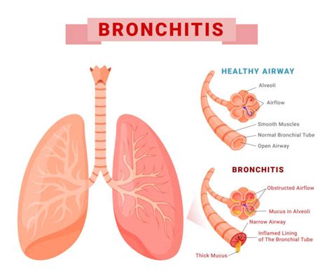 Difference Between Bronchiectasis And Emphysema Dr George