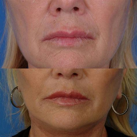 Patient 177570550 Lip Lifts Before And After Photos Dr Angela Sturm