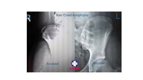Osteochondrosis Apophysitis Other Bone Related Pediatric Injuries