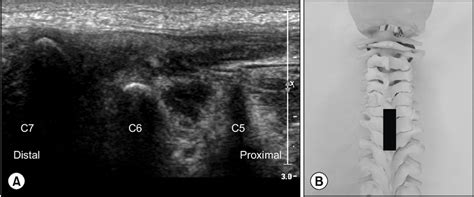 A Ultrasonography On Longi­ Tudinal Scan At Midline Of The Posterior