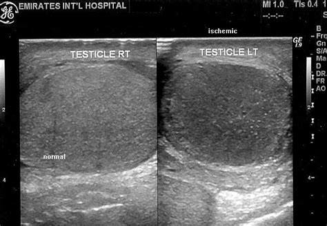 Orchitis Ultrasound