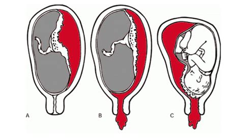Is Placental Calcification Dangerous Vinmec