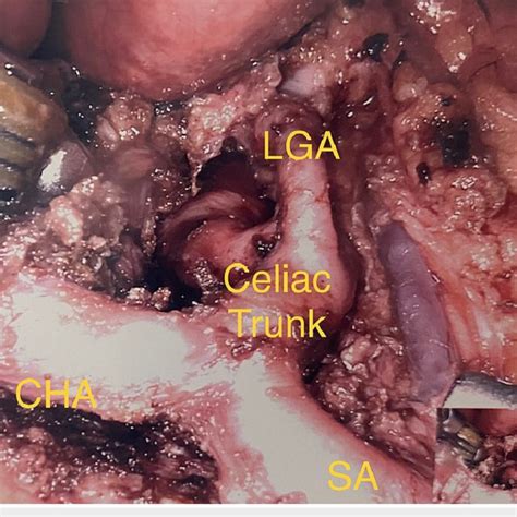 Computed Tomography Angiography Showing Celiac Artery Stenosis Due To Download Scientific