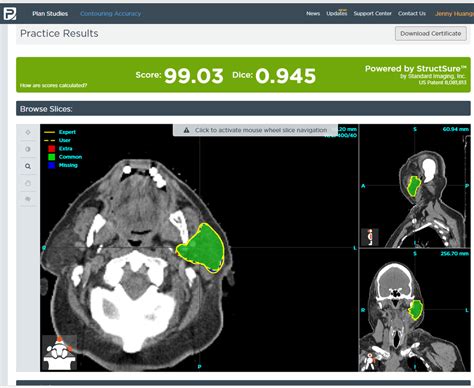Left Parotid Gland Jenny Huang