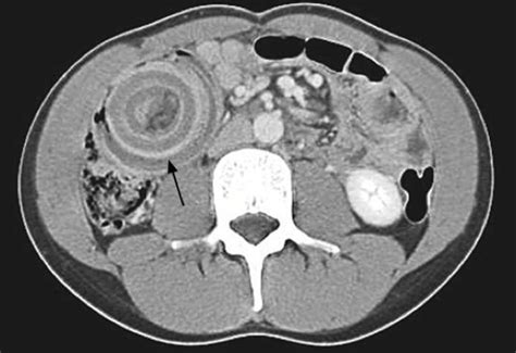 Emergency Medicine Educationadult Intussusception Not