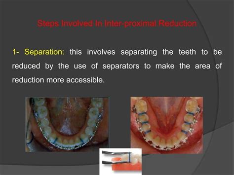 Interproximal Enamel Reduction Stripping Pptx Dental Health Diseases And Conditions
