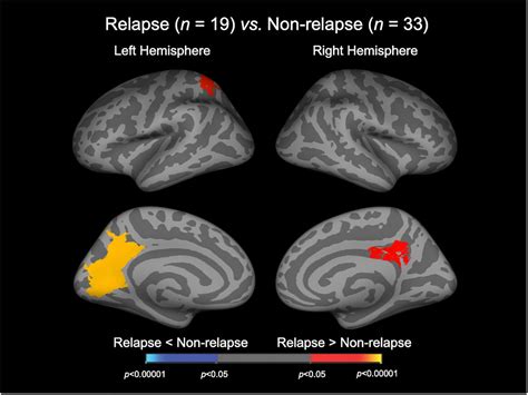 Schizophrenia Brain Comparison