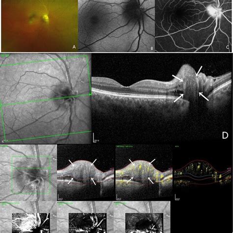 Multi Modal Image Data Of Case 1 A Color Fundus Photography Showed Download Scientific