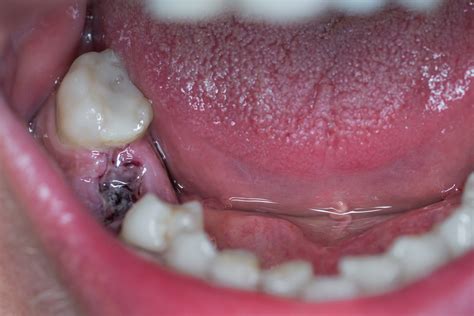 A Dry Socket What Is It Why Does It Happen And How Is It Treated