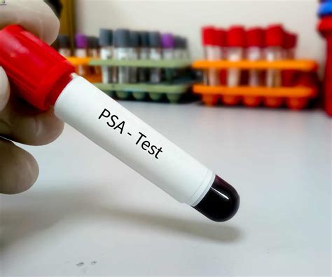 Elevated Psa Lakeview Center For Urology