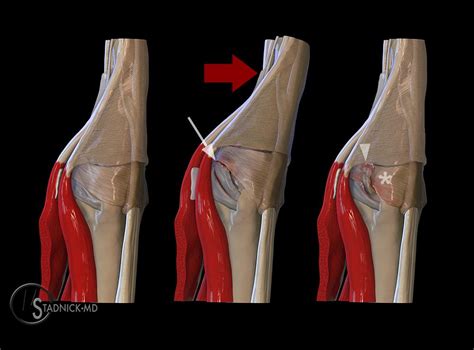 Collateral Ligament Injuries Of The Fingers Radsource