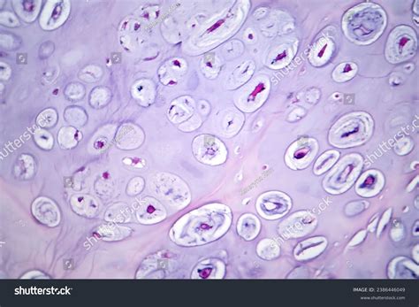 Photomicrograph Chondrosarcoma Malignant Cartilage Tumor Revealing