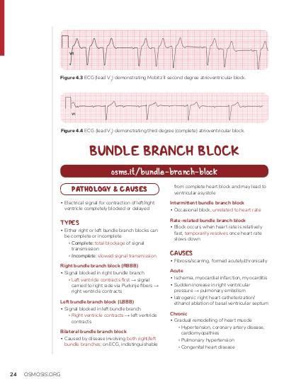 Right Bundle Branch Block