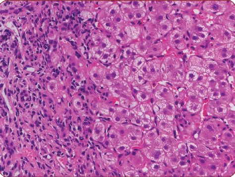 Liver Biopsy Showing Interface Hepatitis With Predominant Lymphocytic Download Scientific