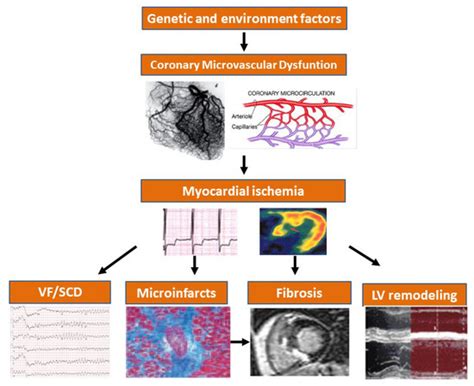 Microvascular Dysfunction In Hypertrophic Cardiomyopathy