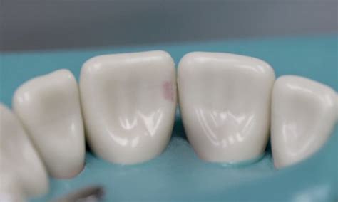 Class Iii Composite Preparation My Dental Key