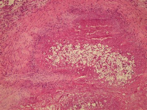 Pathology Outlines Cryptococcus