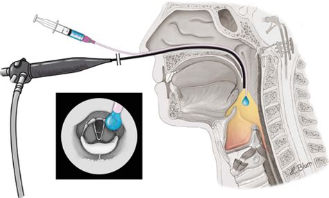Fees‐based Assessment Of Pharyngeal Hypesthesia—proposal And Validation
