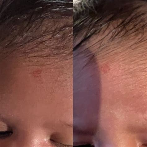 Red Spot On Forehead Mumsnet