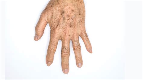 Melanoma Spots On Hands