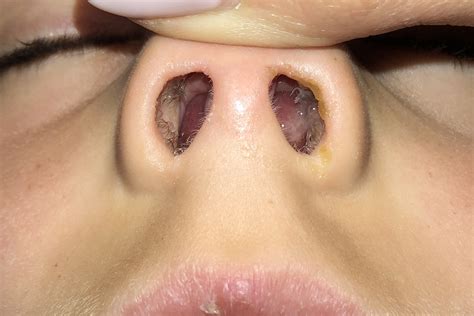 Nasal Septal Hematoma Pictures