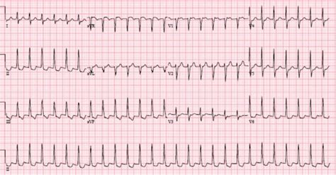 St Elevation In Avr Stemi Equivalent Ecg Cases Emergency Medicine
