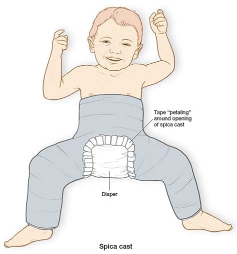 Developmental Dysplasia Of The Hip Causes Symptoms Diagnosis