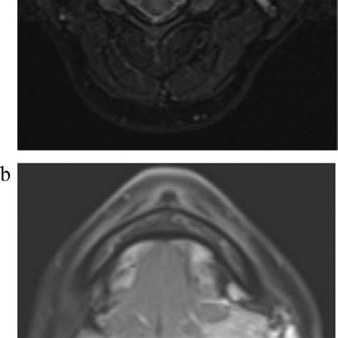 A Stir Sequence Demonstrates A Well Circumscribed Avidly Enhancing