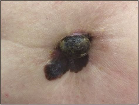 Umbilicus Reconstruction After Melanoma Excision Jcas