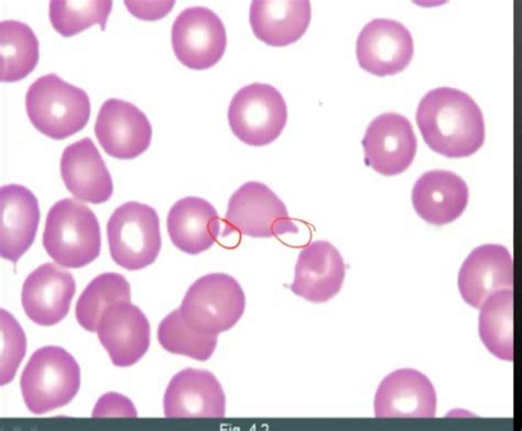 Pathoma 4 1 Primary Hemostasis Flashcards Quizlet