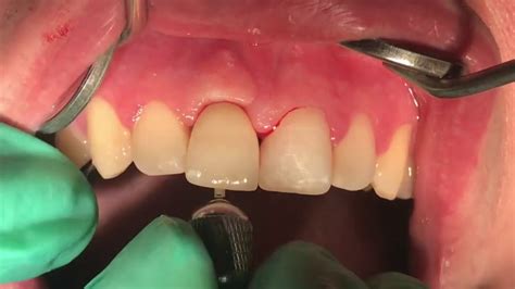 Hoe Ziet Een Kroon Eruit Een Visuele Gids