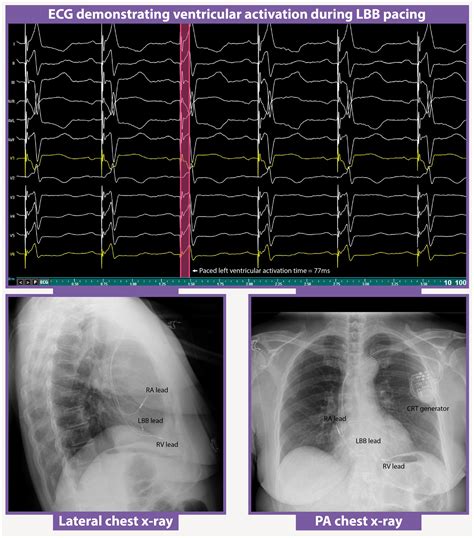 Loss Of Capture Of Conduction System Pacemaker Caused By Fibrosis Surrounding The Lead Revealed