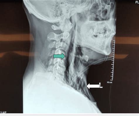 Lateral Neck Radiograph Showing Extension Dissection Of Prevertebral