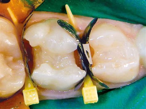 Class I Iv Caries Pulpdent