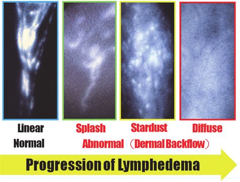 Characteristic ICG Lymphography Findings With Progression Of Download Scientific Diagram