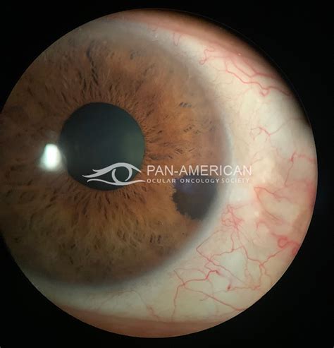 Iris Nevus Sociedad Panamericana De Oncología Ocular Paoos