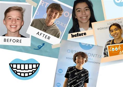 Your Go To Guide To Lightforce Braces Ox Orthodontix®