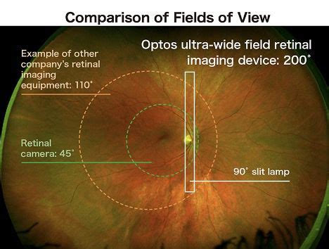 Optos® Vs Dilation A Comprehensive Eye Exam Comparison Optyx Home