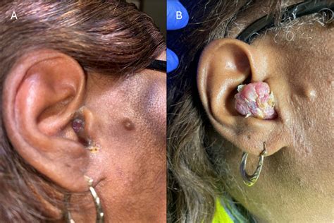 Large Fibroepithelial Polyp Initially Misdiagnosed As Hemangioma Of The