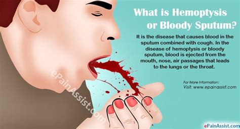 Hemoptysis Or Bloody Sputumtypessymptomscomplicationsdiagnosis