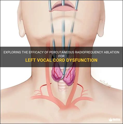 Exploring The Efficacy Of Percutaneous Radiofrequency Ablation For Left Vocal Cord Dysfunction