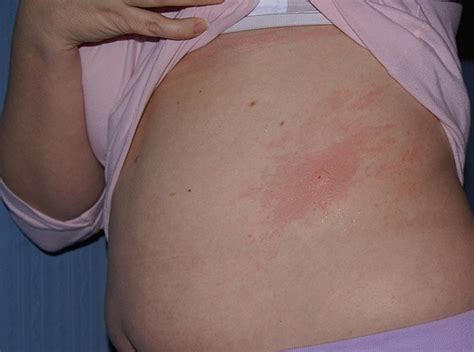 Do Wasps Sting Or Bite Smore Science