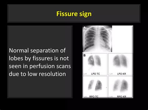 Figure 3 Sign Fleischner Sign Fissure Sign Headcheese Sign Hilar Overlay Sign The Anterior