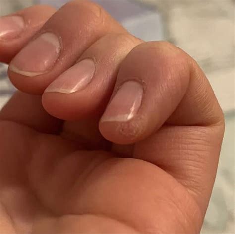 Can Tou Help Me Identify If This Is A Wart Rwarts