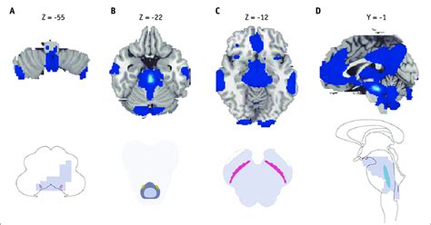 The Locational Relationships Between Lesion Network Mapping For Rapid