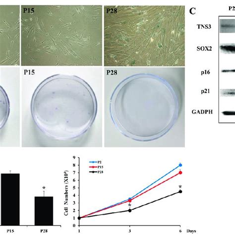Figure Showing Grade 3 Adenoid Hypertrophy According To Clemens