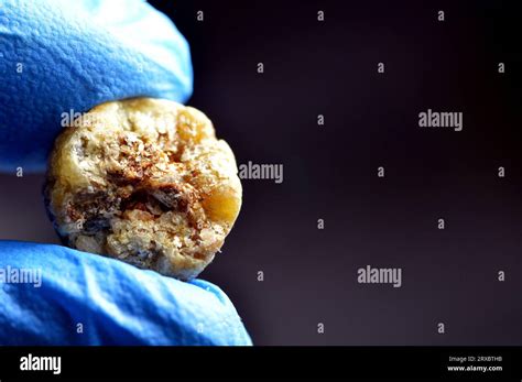 Calcoli Biliari Grandi Rimossi Chirurgicamente Dopo Colecistectomia Laparoscopica Calcoli