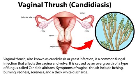 Vaginal Candidiasis Discharge
