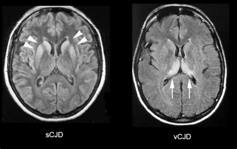 Encephalopathies Flashcards Quizlet