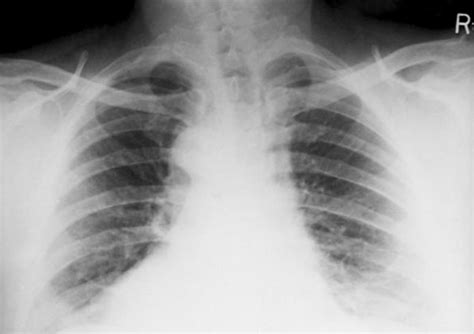 3 Gejala Antraks Pada Manusia Berdasarkan Penularannya